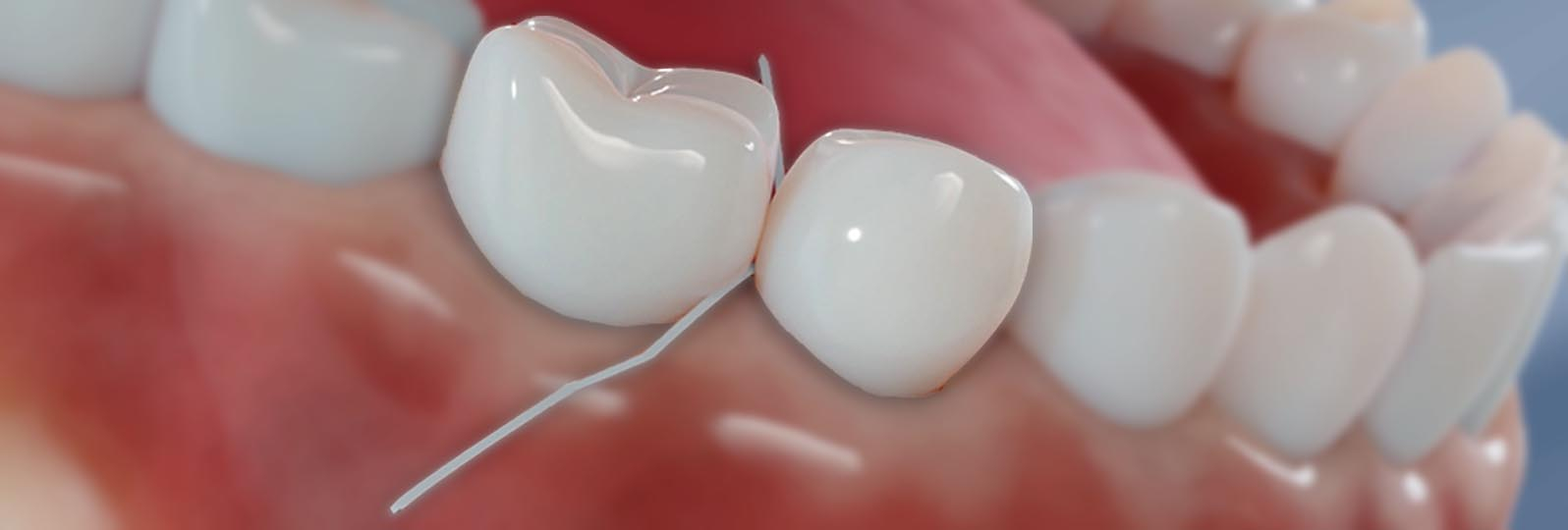 Beyond Brushing: How to Floss with Proper Technique - Avery Ranch Dental