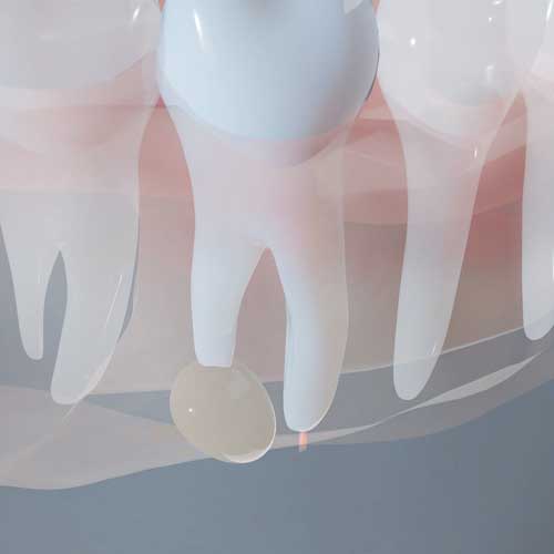 The Truth About Tooth Infections - Avery Ranch Dental